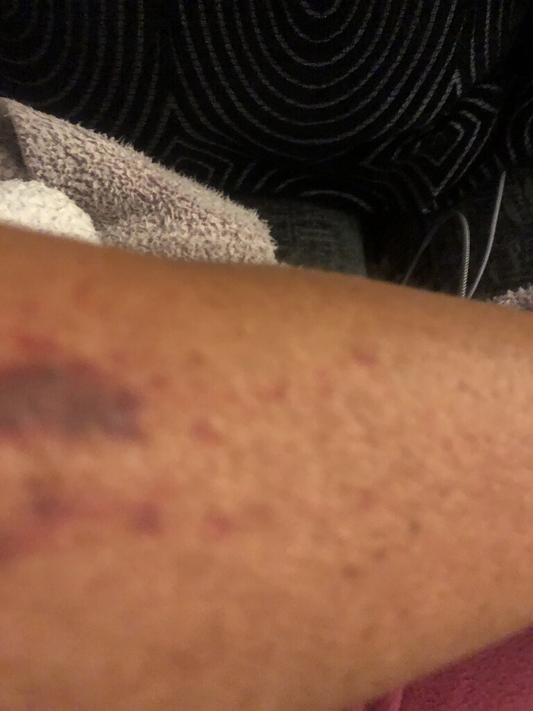 Tablets causing itching and sores - Physical effects - Stroke ...